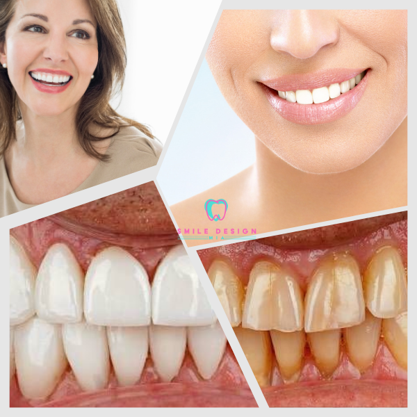 Crafting Radiant Dental Smile Design Miami | Dental Smile Mia